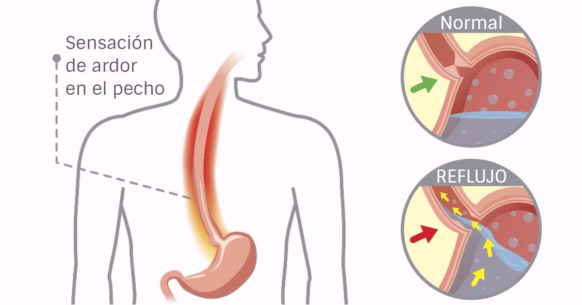 Elimina la acidez estomacal con estos 5 remedios naturales