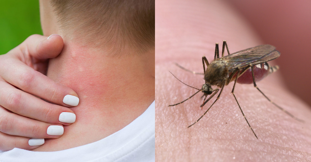 ¿Qué me picó? Aprende a reconocer las diferentes picaduras de insectos